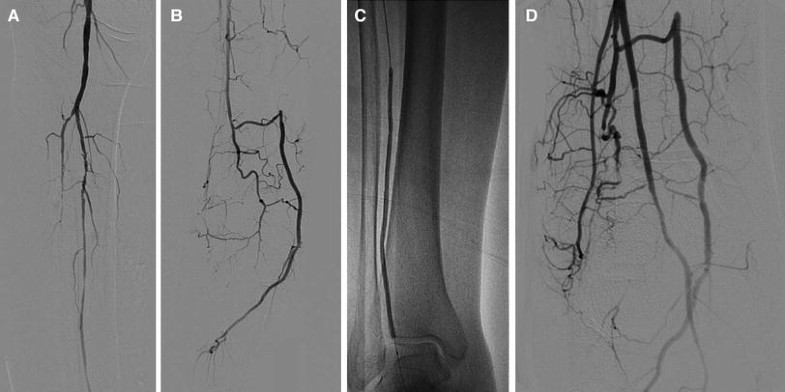 Endovascular Treatment of Diabetic Foot in a Selected Population of ...