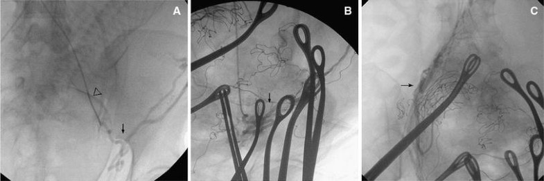 Prophylactic Uterine Artery Embolization Assisted Cesarean Section for ...