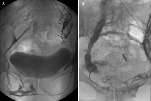 Female Pelvic Vein Embolization: Indications, Techniques, and Outcomes ...