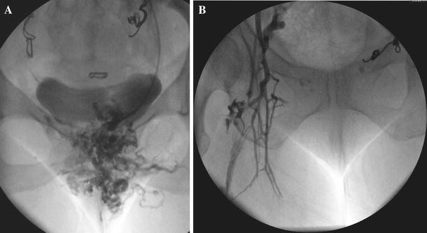 Female Pelvic Vein Embolization: Indications, Techniques, and Outcomes ...