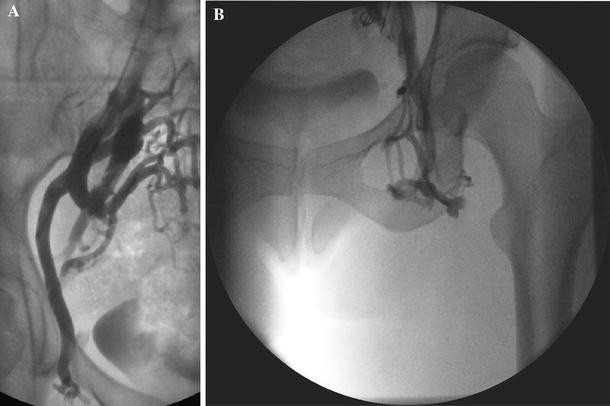 Female Pelvic Vein Embolization: Indications, Techniques, and Outcomes ...