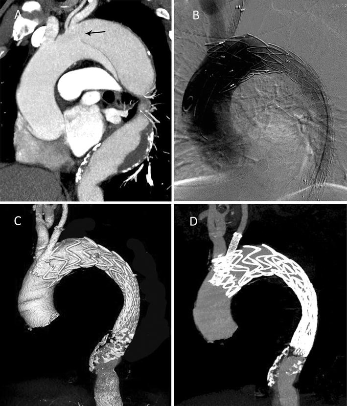 Early Results of Chimney Technique for Type B Aortic Dissections ...