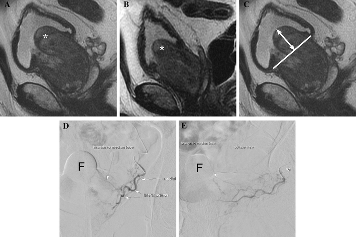 Intra-vesical Prostatic Protrusion (IPP) Can Be Reduced by Prostatic ...