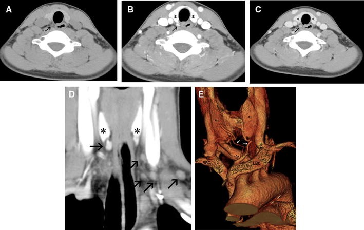 The Essentials of Parathyroid Hormone Venous Sampling | SpringerLink