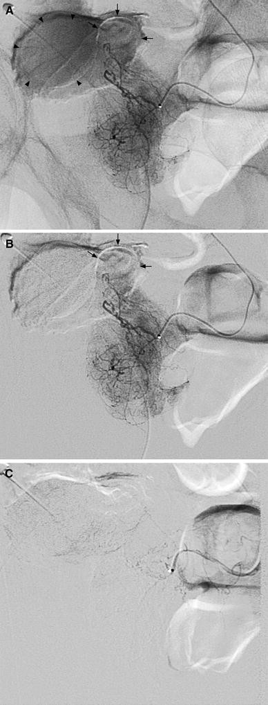 Prostate Artery Embolization for Complete Urinary Outflow Obstruction ...
