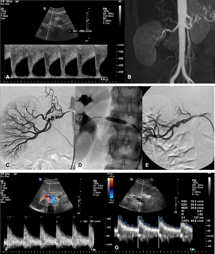 Cutting Balloon Angioplasty (CBA) for the Treatment of Renal Artery ...
