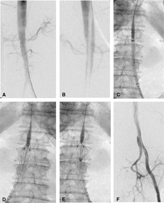 Human Thiel-Embalmed Cadaveric Aortic Model with Perfusion for ...