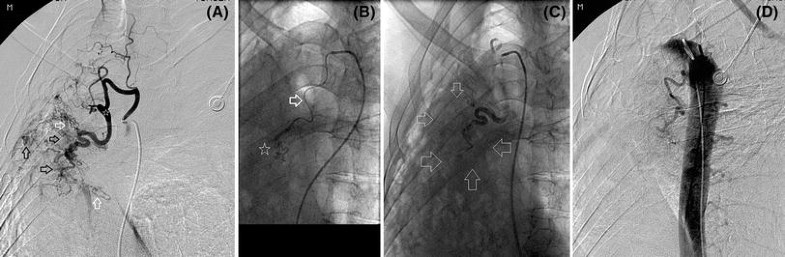 Bronchial Artery Embolization with Large Sized (700–900 µm) Tris-acryl ...