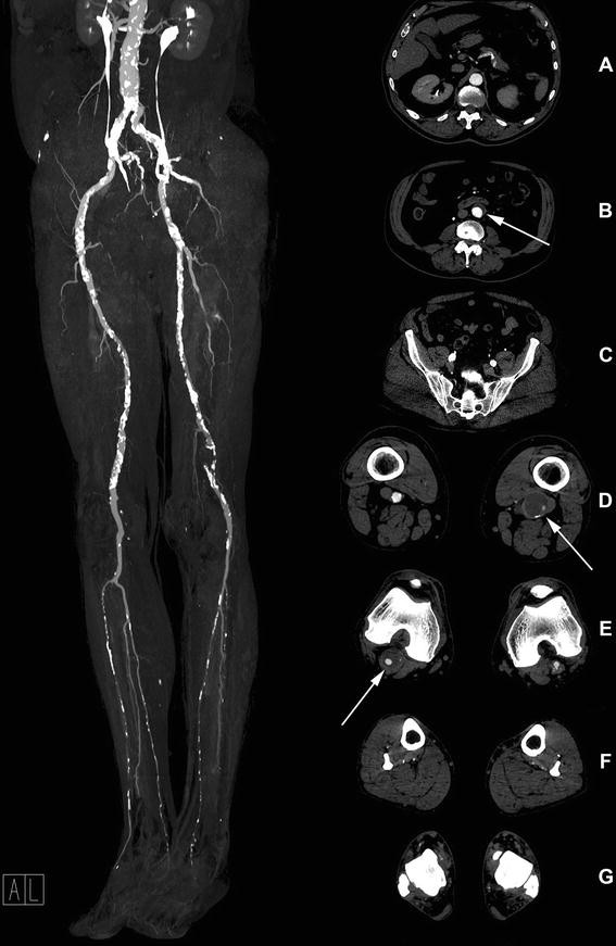 CT Angiography in the Lower Extremity Peripheral Artery Disease ...