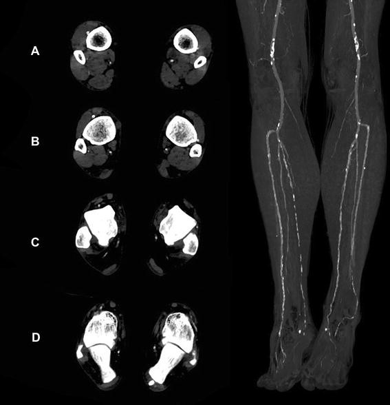 CT Angiography in the Lower Extremity Peripheral Artery Disease ...