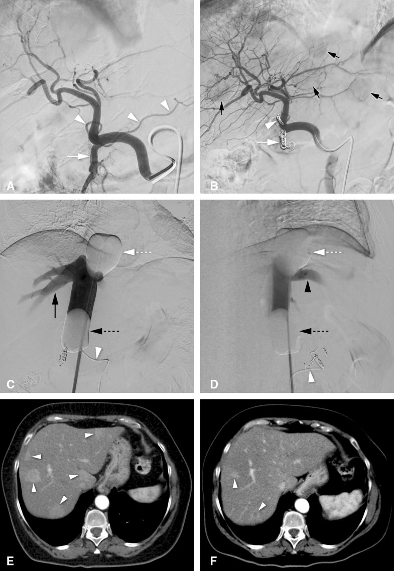 Safety of Percutaneous Hepatic Perfusion with Melphalan in Patients ...