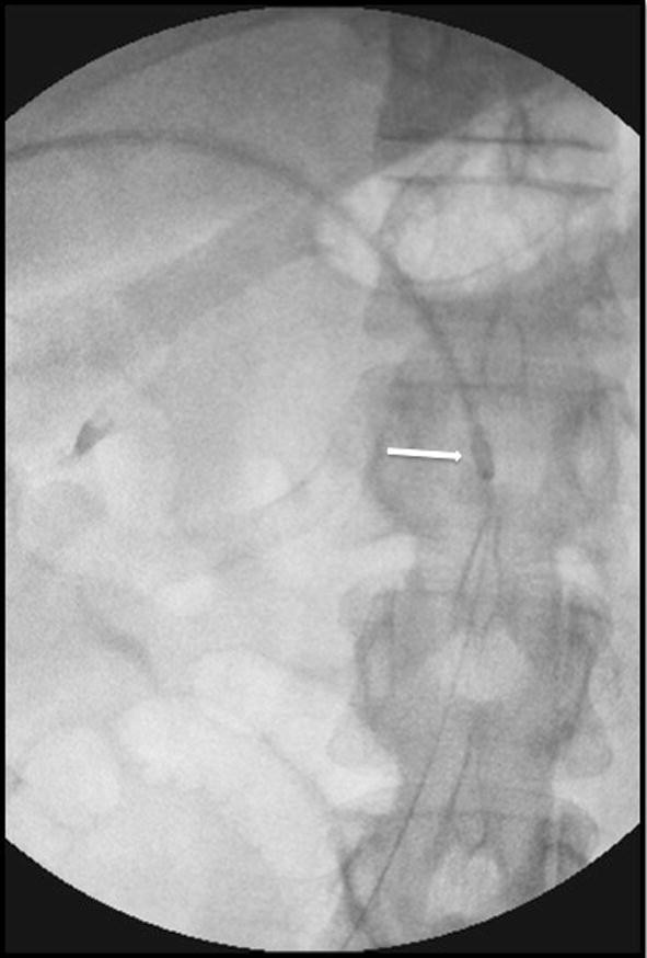 Percutaneous Pharmaco-Mechanical Thrombectomy of Acute Symptomatic ...