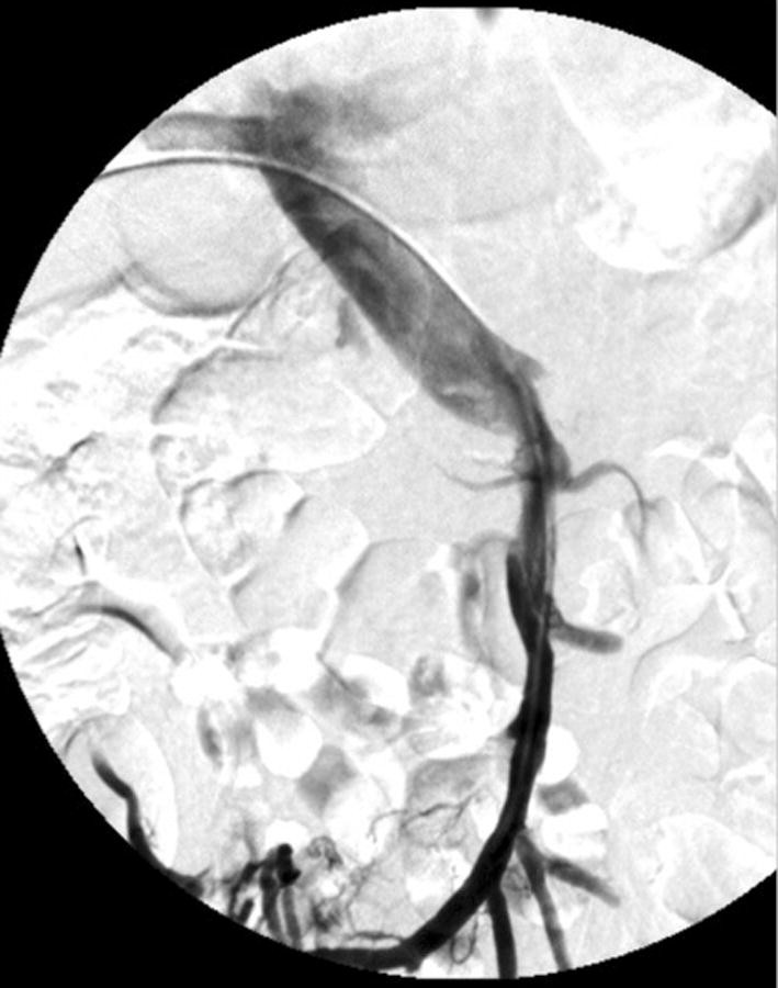 Percutaneous Pharmaco-Mechanical Thrombectomy of Acute Symptomatic ...