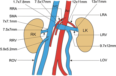 An unusual case of left venous renal entrapment syndrome: a new type of ...