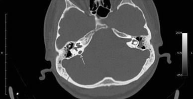 High and dehiscent jugular bulb: clear and present danger during middle ...