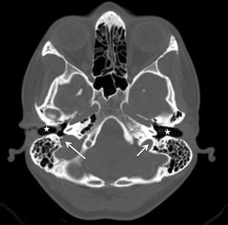 High and dehiscent jugular bulb: clear and present danger during middle ...