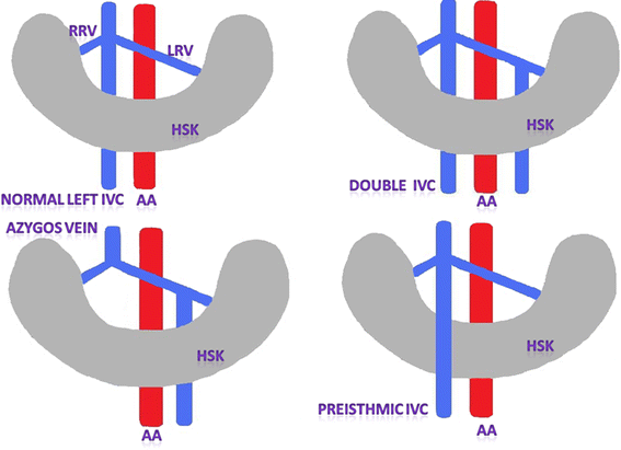 Horseshoe kidney: a review of anatomy and pathology | SpringerLink