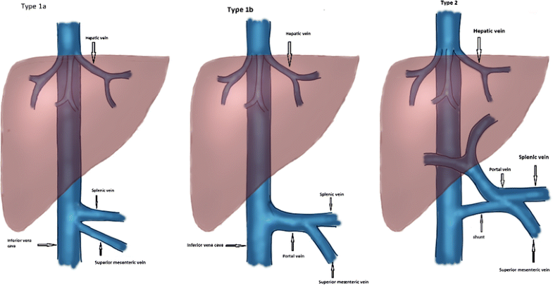 Multiple regenerative nodular hyperplasia in the left infrarenal vena ...