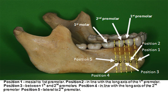 Finding the mental foramen | SpringerLink