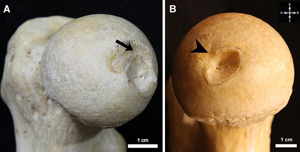 The morphology and morphometry of the fovea capitis femoris | SpringerLink