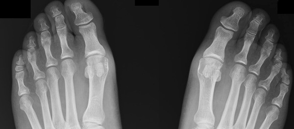 The prevalence and ossification pattern of the biphalangeal and ...