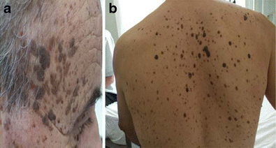 The Leser–Trelat sign is a associated with acute myeloid leukemia ...