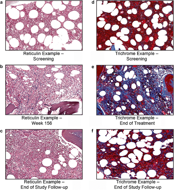 Changes in bone marrow morphology in adults receiving romiplostim for ...