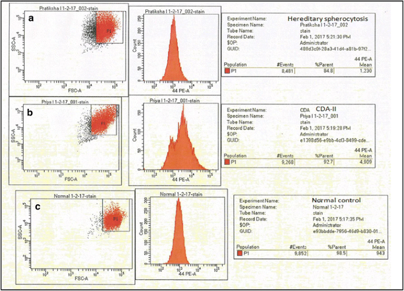 Congenital dyserythropoietic anemia type II mimicking hereditary ...