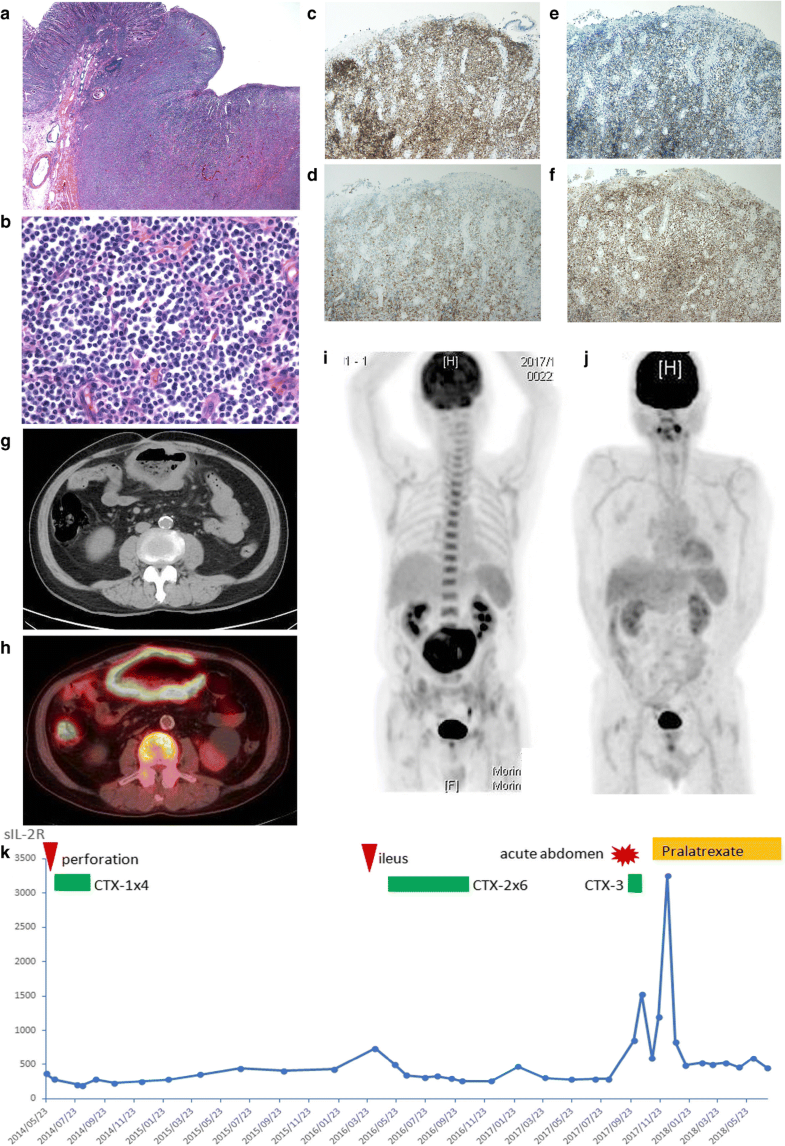 Successful treatment of monomorphic epitheliotropic intestinal T cell ...