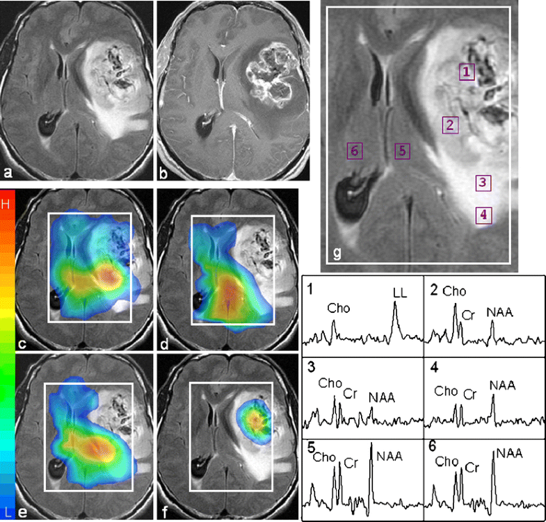 Proton MR spectroscopy of the brain at 3 T: an update | SpringerLink