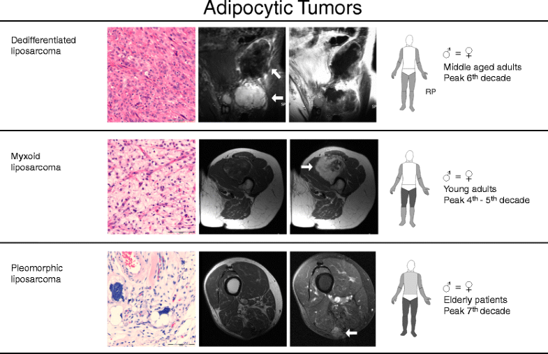 Soft tissue sarcomas at a glance: clinical, histological, and MR ...