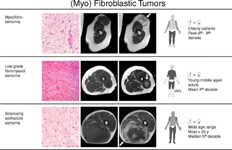 Soft tissue sarcomas at a glance: clinical, histological, and MR ...