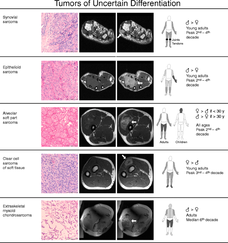Soft tissue sarcomas at a glance: clinical, histological, and MR ...