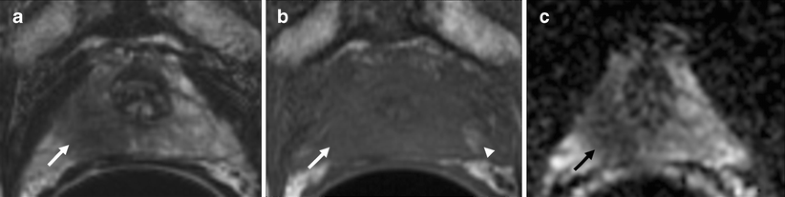 Diffusion weighted imaging in prostate cancer | SpringerLink
