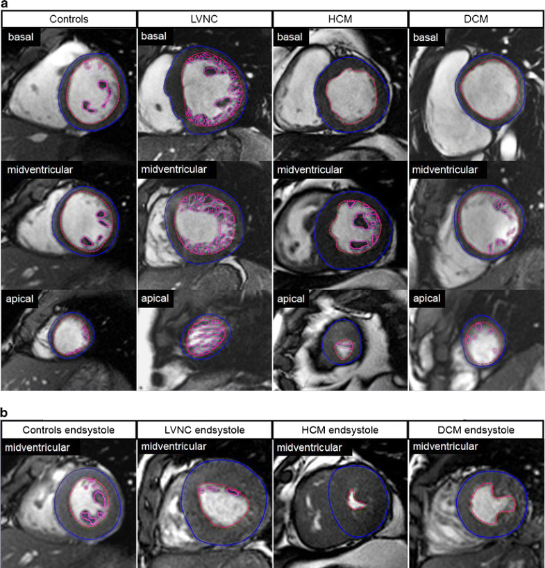 Value of cardiovascular MR in diagnosing left ventricular non ...