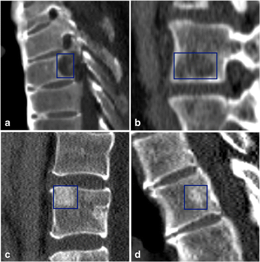 Automatic detection of lytic and blastic thoracolumbar spine metastases ...