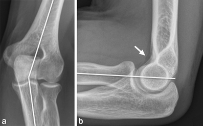 Traumatic instability of the elbow - anatomy, pathomechanisms and ...
