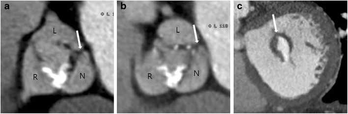 Fused aortic valve without an elliptical-shaped systolic orifice in ...