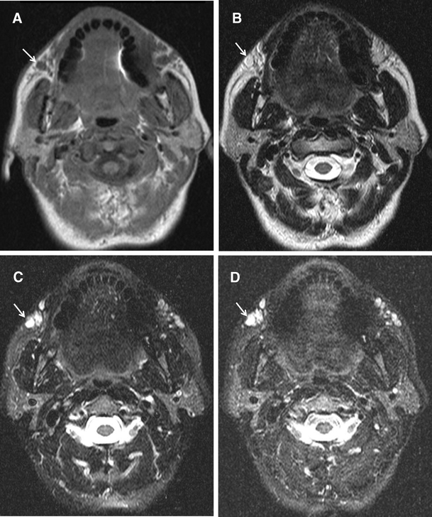 MRI in the evaluation of facial dermal fillers in normal and ...