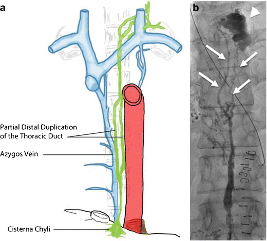 The thoracic duct: clinical importance, anatomic variation, imaging ...
