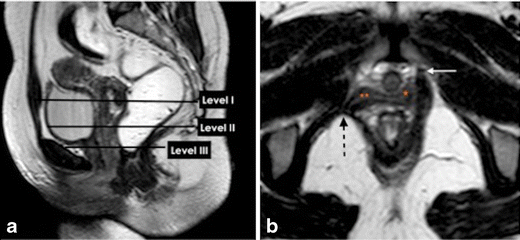 Magnetic resonance imaging of pelvic floor dysfunction - joint ...
