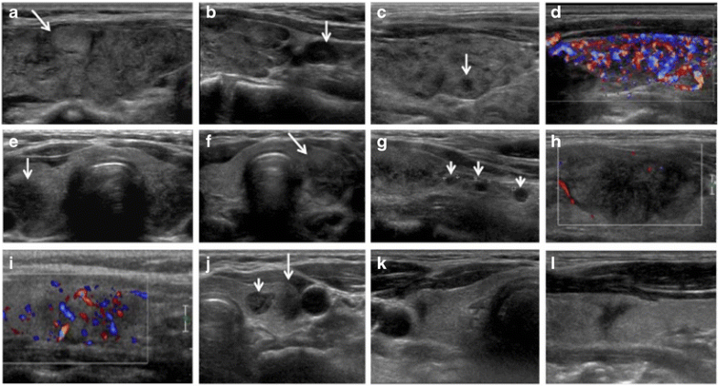 Prospective validation of the ultrasound based TIRADS (Thyroid Imaging ...