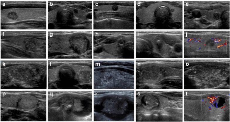 Prospective validation of the ultrasound based TIRADS (Thyroid Imaging ...
