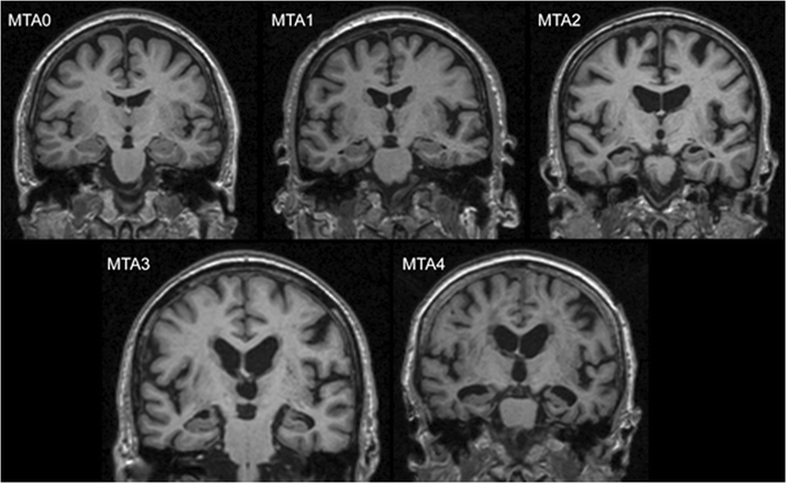 Medial temporal lobe atrophy ratings in a large 75-year-old population ...