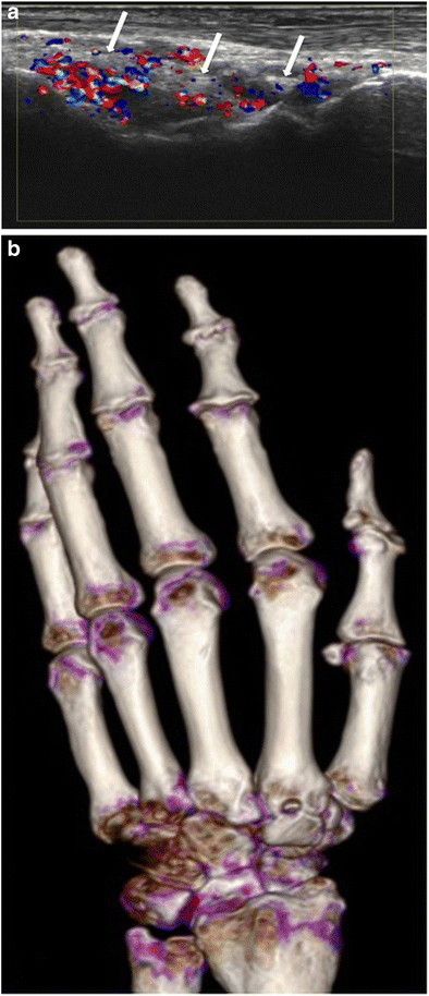 Gout of hand and wrist: the value of US as compared with DECT ...