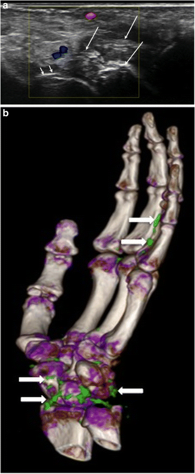 Gout of hand and wrist: the value of US as compared with DECT ...