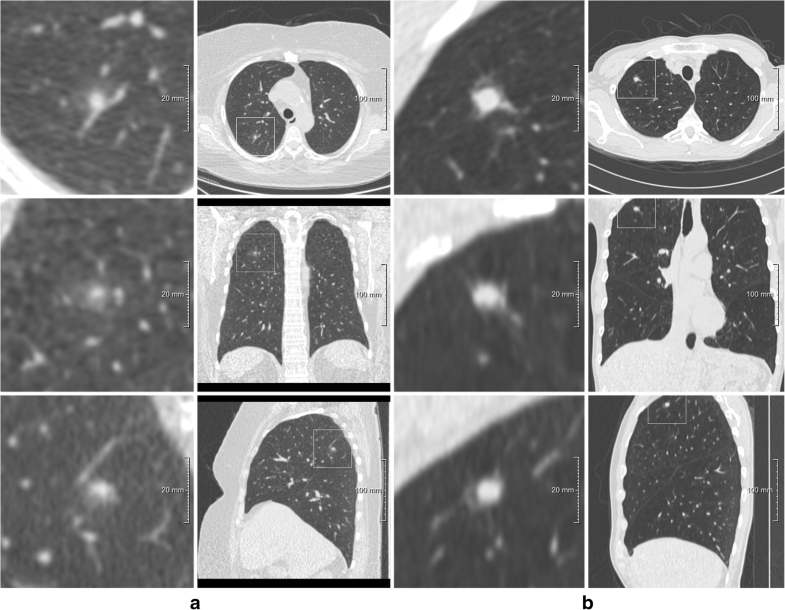 Observer variability for Lung-RADS categorisation of lung cancer ...