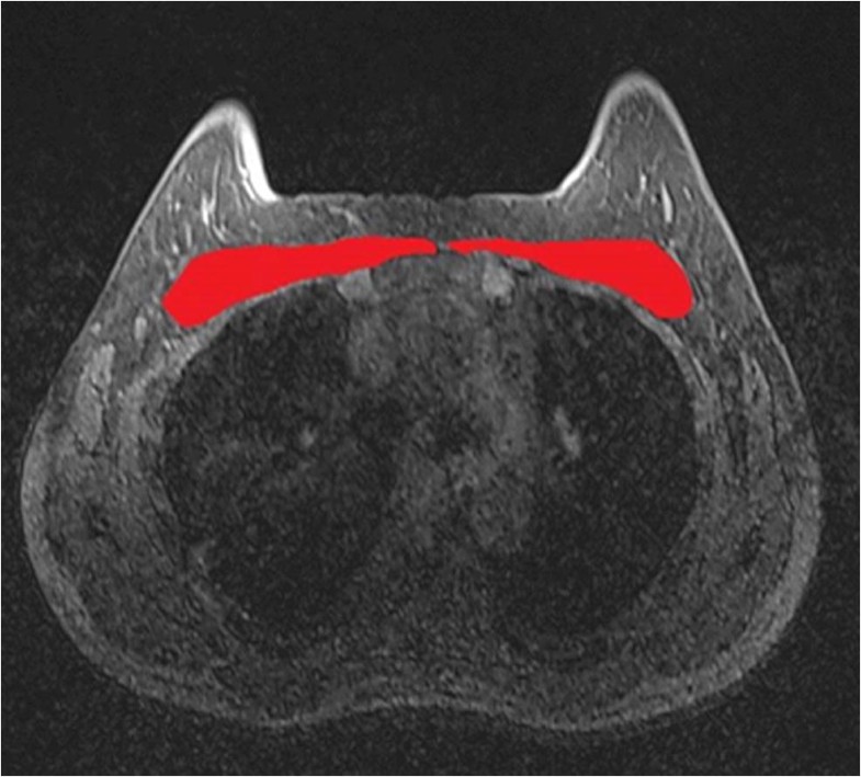 Muscle mass estimation on breast magnetic resonance imaging in breast ...