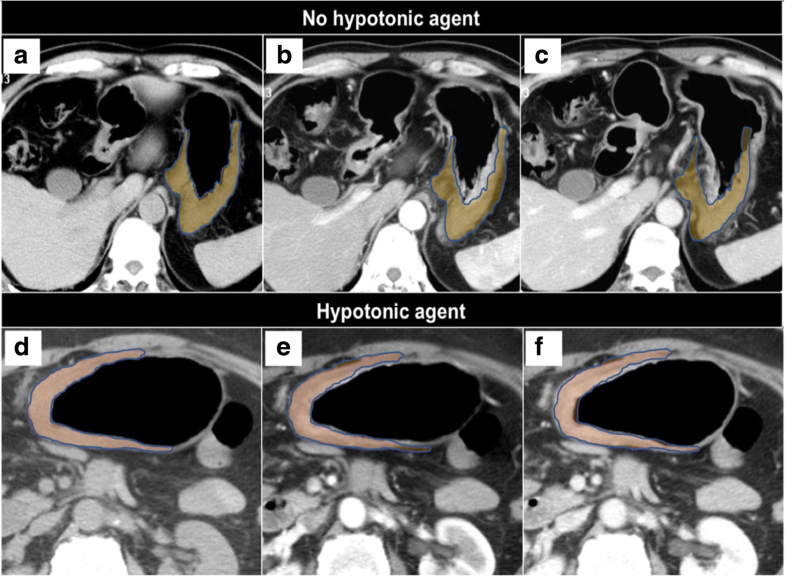 Gastric cancer and imaging biomarkers: Part 1 – a critical review of DW ...