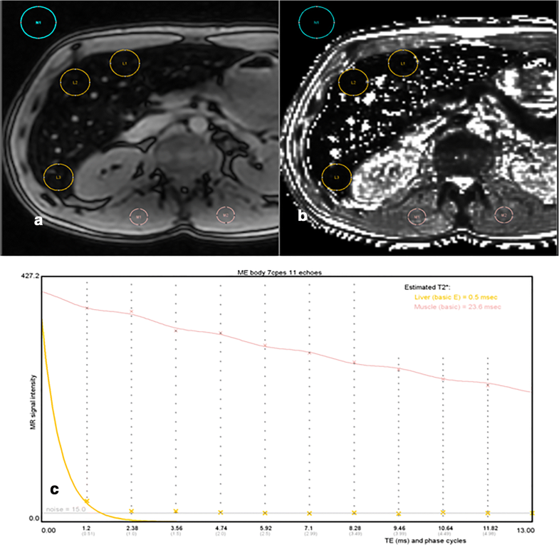 Practical guide to quantification of hepatic iron with MRI | SpringerLink